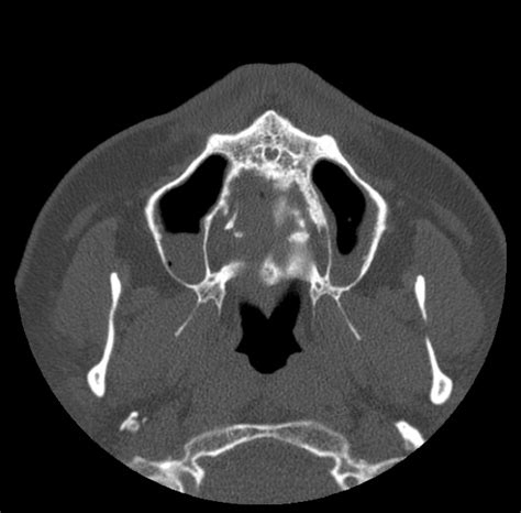 Acute Sinusitis Radiopaedia 23161 23215 Axial Bone Window Nc Commons