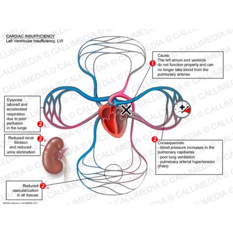 Cardiac Insufficiency