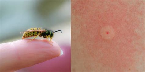 Bug Bites And Stings Pictures Identification Treatment Business