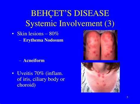 Ppt Beh Ç Ets Disease Powerpoint Presentation Free Download Id