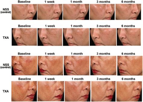 Tri Luma Cream Results And Reviews Does It Work