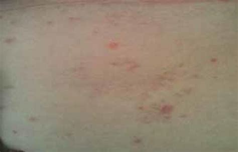 Schistosomiasis Rash