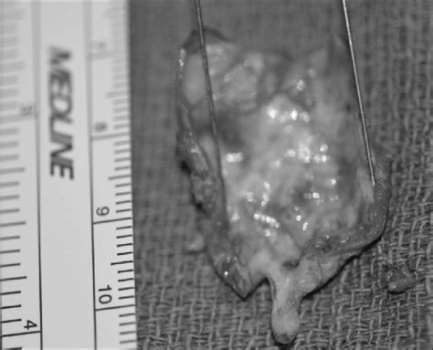 Ulcerative Plaque Surgically Removed From A Patient Who Presented With