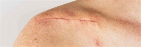 Après Une Chirurgie Tout Savoir Sur Vos Cicatrices Ixxliq