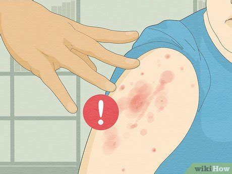 How To Recognize A Scabies Rash With Pictures
