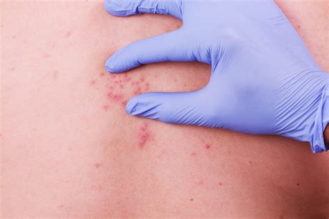 Infectia Cu Virus Varicelo Zosterian Epidemiologie Si Tratament