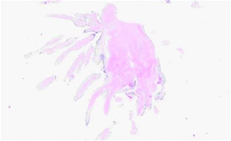 Photomicrograph Of A Fibroelastoma Photomicrograph Of Papillary
