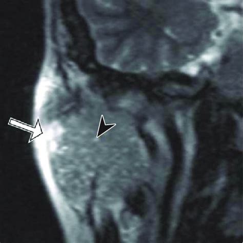 Conjunctival Injection Download Scientific Diagram