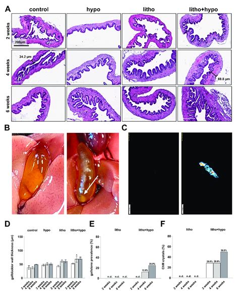 Thyroid Hormone Deficiency Increases Gallbladder Wall Thickness And