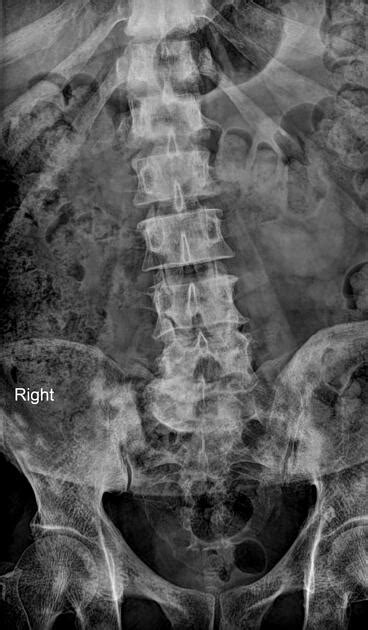 Osteoblastic Bone Lesions