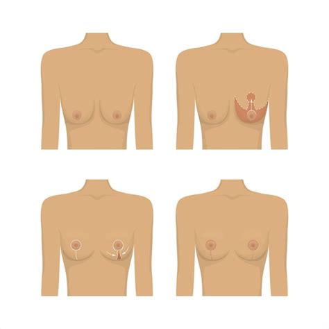 Premium Vector Lifting Breast Plastic Surgery Cosmetic Procedure Of