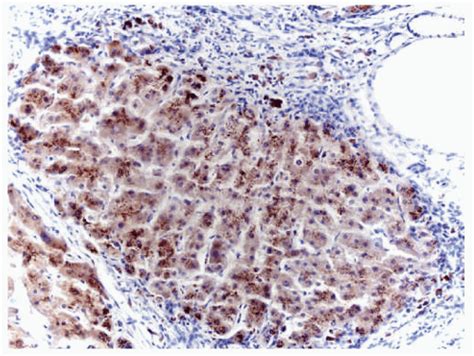 Cholestatic Liver Disease And Biliary Tract Disease Basicmedical Key