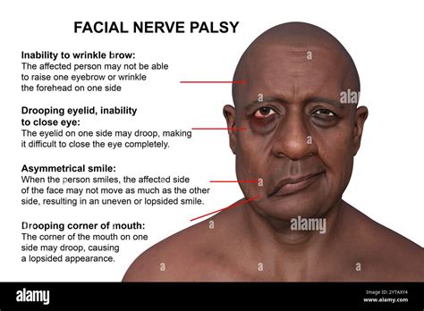 Facial Palsy In A Man Computer Illustration Highlighting The Asymmetry