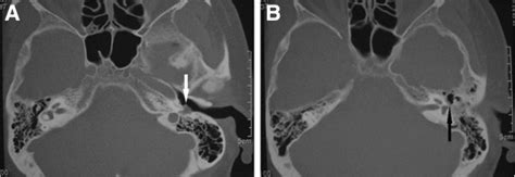 Axial Computed Tomography Of The Temporal Bone Shows A Slightly