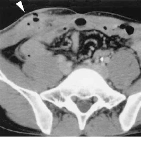Contrast Enhanced Ct Image Of Sigmoid Colon Perforation Caused By