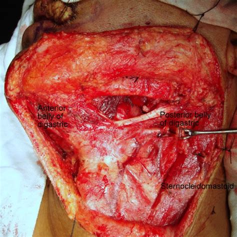 Post Modified Radical Neck Dissection On Left Side Download