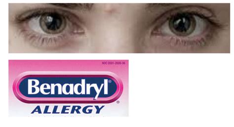 Pupil Testing Part 2 Efferent Defects Flashcards Quizlet