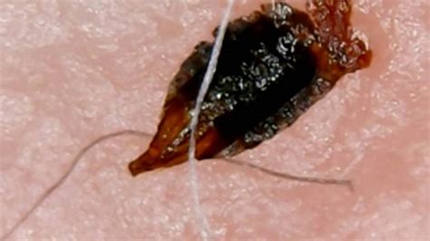 My Nanobot Arent Ufos Aliens Parasites Morgellons Implants Tiny