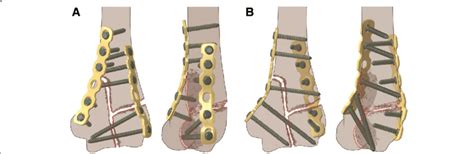 The Patterns Of The Novel Plating A And Orthogonal Plating B The