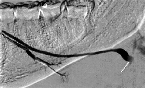 Sialolithiasis Sialography Right Submandibular Duct Sialogram In A