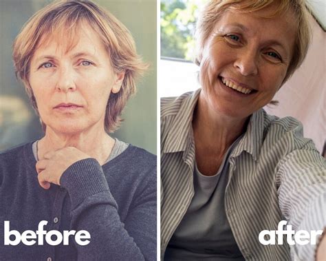 Sermorelin Results Of Our Patients Before And After Pics