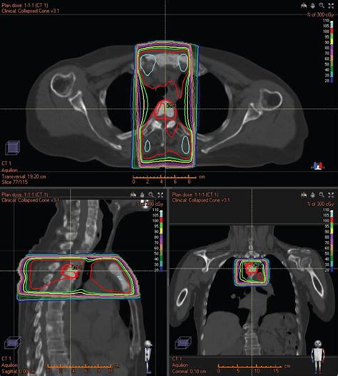 Field Of Palliative Radiotherapy Radiotherapy Was Performed For The