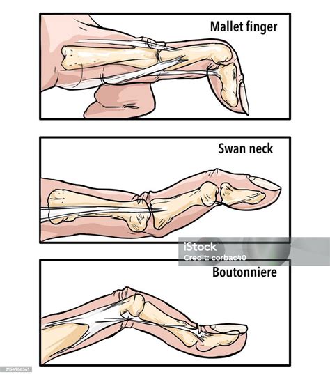 Finger Injuries Vector Illustration Stock Illustration Download Image