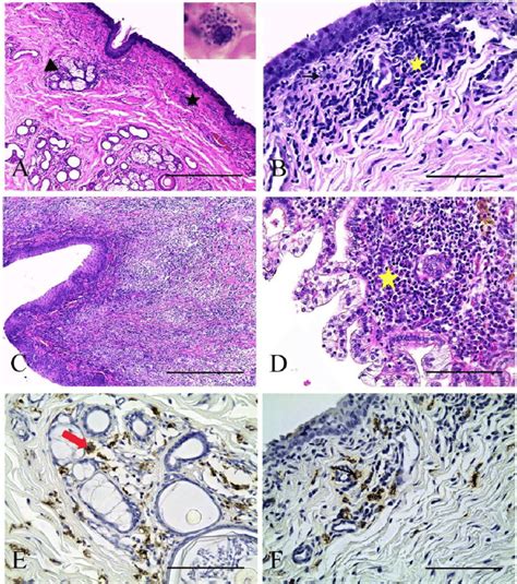 A Vulva Diffuse Moderate Chronic Inflammatory Infiltrate In