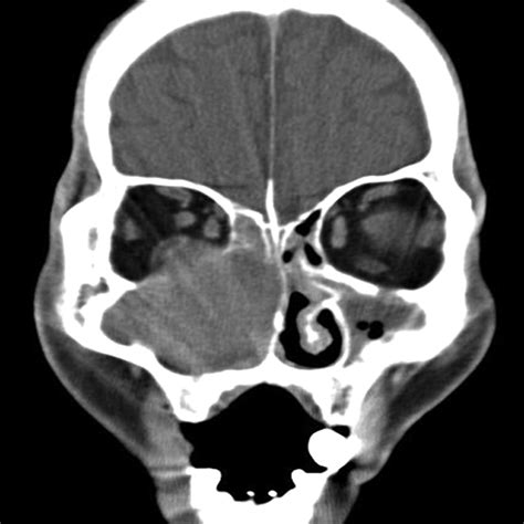 Maxillary Sinus Hematoma Case Of The Week 17 Year Old Male Sickle