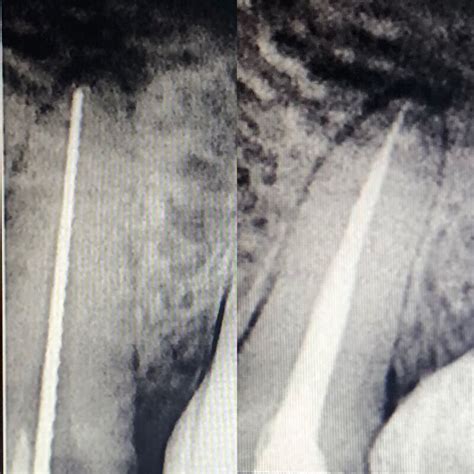 Dr Huma Abbasi On Linkedin Unlocking The Secrets Of Tooth Preservation Through The Art Of…