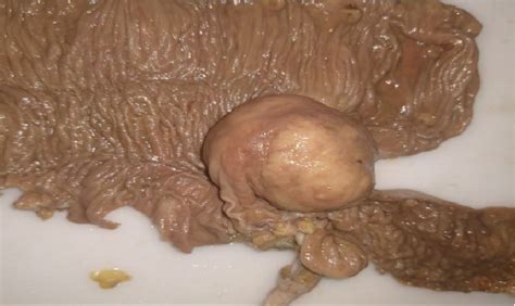 Figure 1 From Vaneks Tumor A Rare Differential Diagnosis Of Colonic