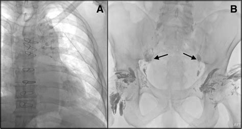 On Post Operative Day 32 Lymphangiogram Detected Patchy Areas Of