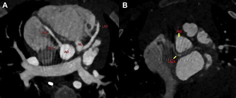 Anomalous Left Anterior Descending Coronary Artery With Retroaortic