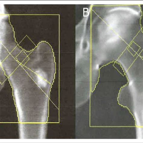 Benign Bone Lesions Are Frequently Encountered On Dual Energy X Ray Download Scientific Diagram
