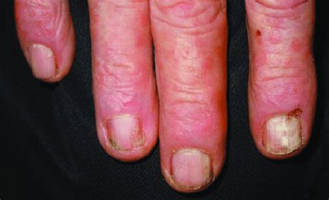 Characteristic Linear Nail Defects Download Scientific Diagram