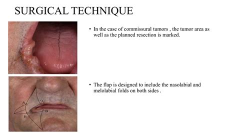 Jc Zisser Flap Pptx Oral And Maxillofacial Surgery Pptx