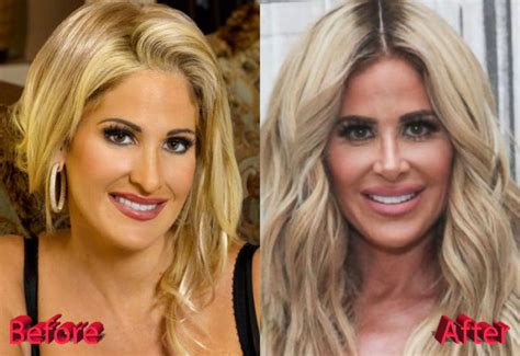 Kim Zolciak Plastic Surgery All Nips And Tucks For The Tv Star