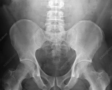 Pelvic X Ray Stock Image P1160713 Science Photo Library