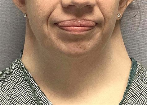 Female Webbed Neck Front 1a Dr Barry Eppley Explore Plastic Surgery