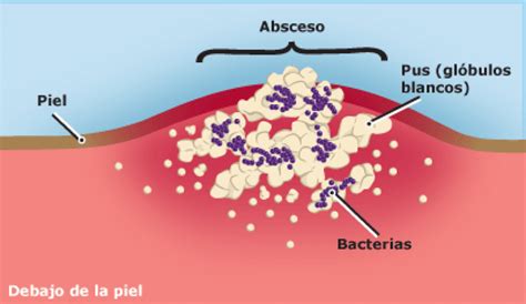 How Long Does An Abscess Take To Heal