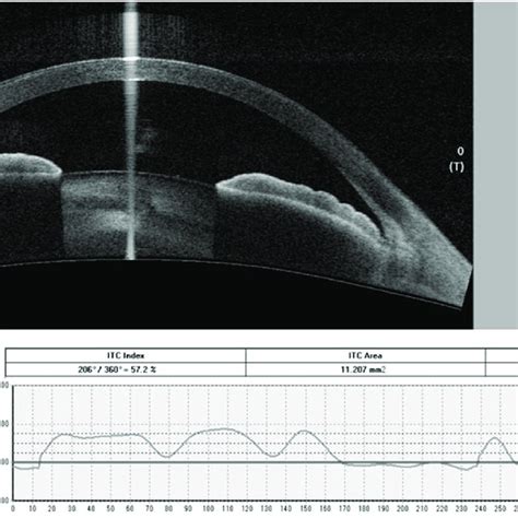 The Iris Trabecular Contact Itc Index Analysis A Ss Oct Meridional Download Scientific