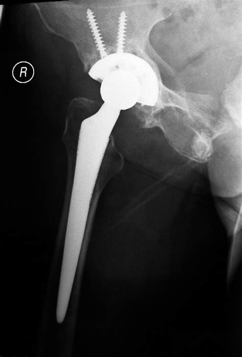 Total Hip Replacement X Rays At Jasmine Leschen Blog