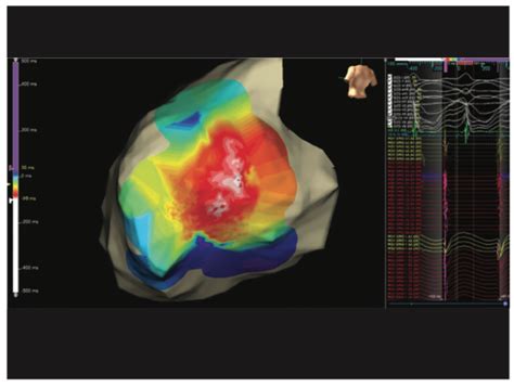 Pacemaker Exit Block An Unusual Cause Of Ventricular Tachycardia