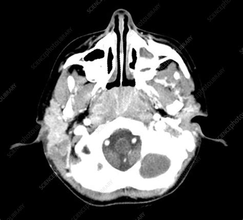 Mastoiditis And Abscess Ct Scan Stock Image C0271802 Science Photo Library