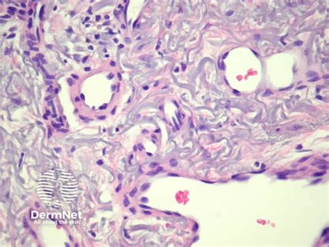Acquired Elastotic Haemangioma Pathology