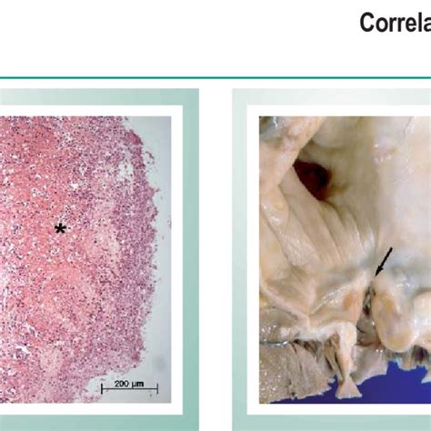 Pdf Caso 12007 Enterorragia E Choque Em Mulher De 69 Anos Portadora De Estenose Mitral