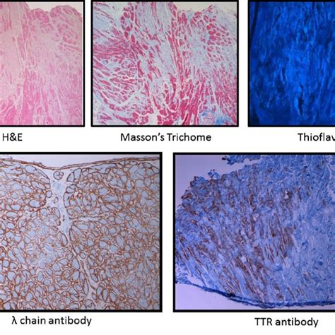 Endomyocardial Biopsy With Different Staining Of Cardiac Amyloidosis