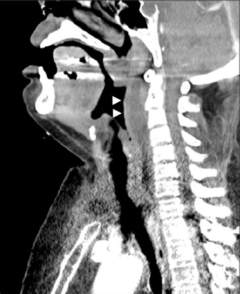 Sagittal Images From An Initial Contrast Enhanced Neck Computed
