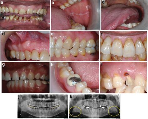 Occlusal Loading Force At Charles Dunaway Blog