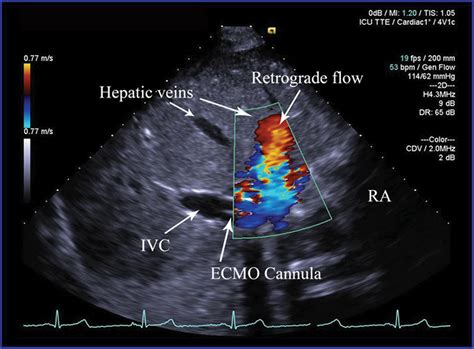 Tte Subcostal Window Long Axis Ivc Plane Color Doppler Mode Massive